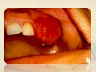 Exophytic lesion in the oral cavity | PPT
