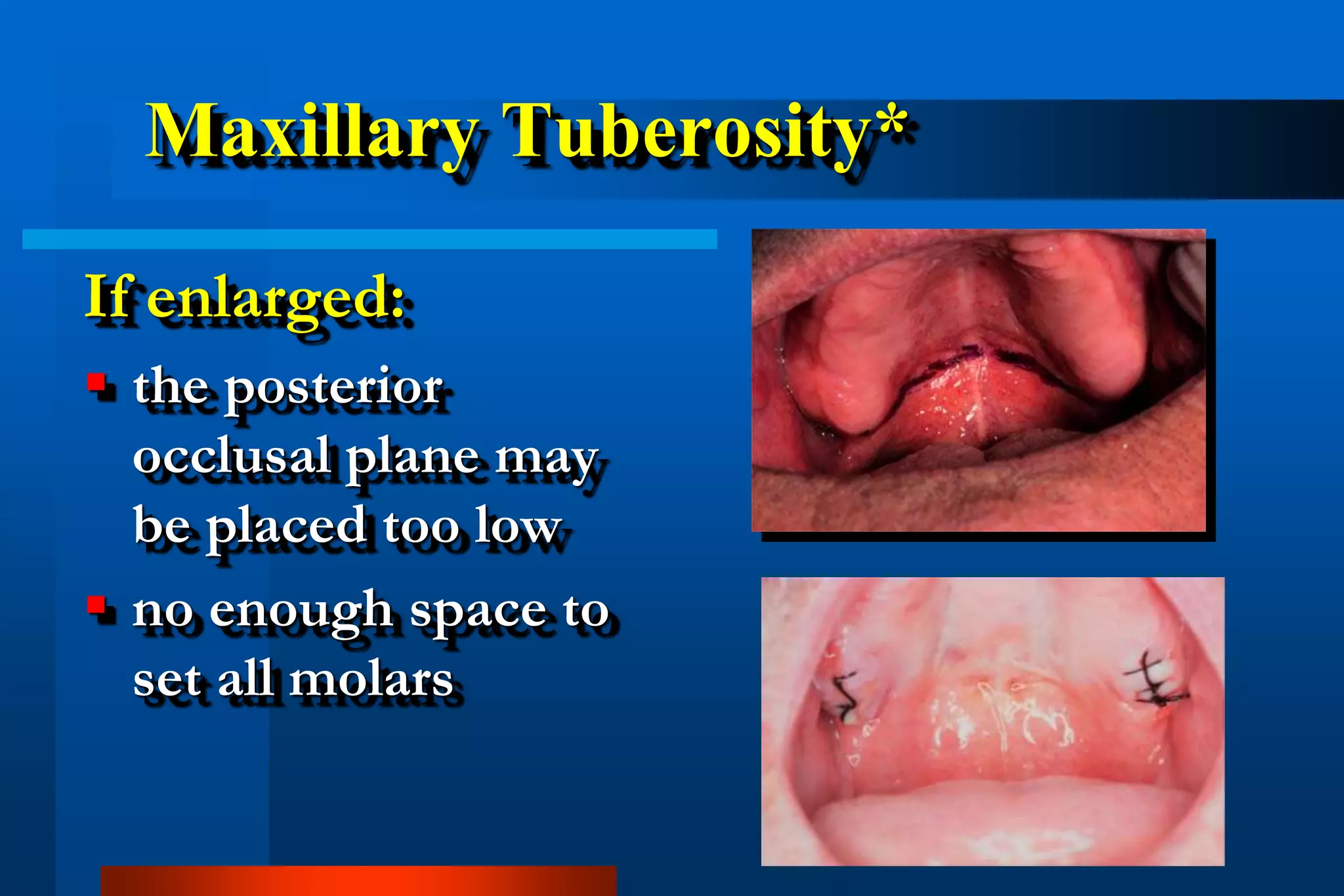 Diagnosis & treatment plan of completely Edentulous Patients | PPTX