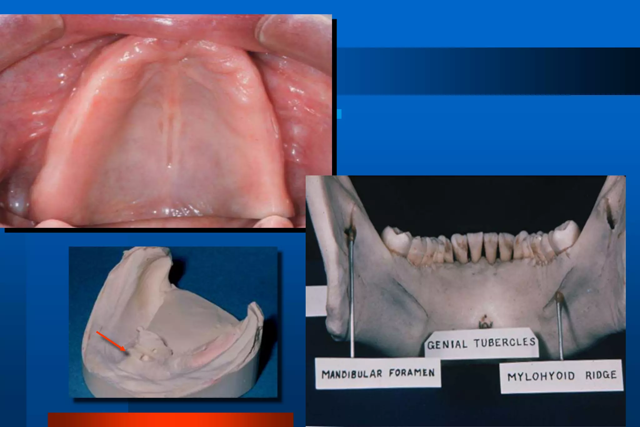 Diagnosis & treatment plan of completely Edentulous Patients | PPTX