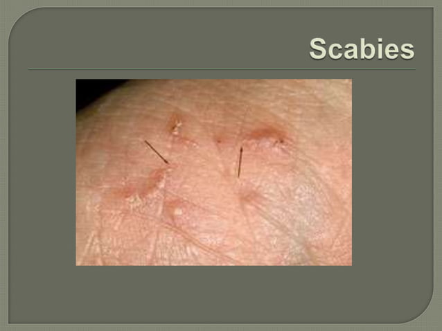 Diagnosis banding kudisan | PPTX