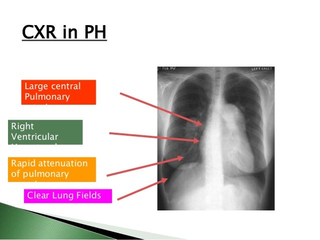 Diagnosis of Pulmonary Hypertension