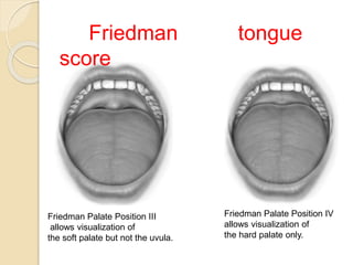 Diagnosis and investigations of Obstructive sleep apnea | PPT