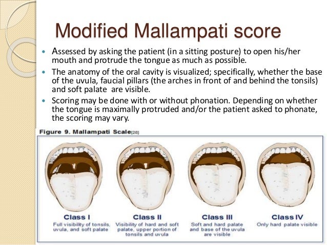 Diagnosis and investigations of Obstructive sleep apnea