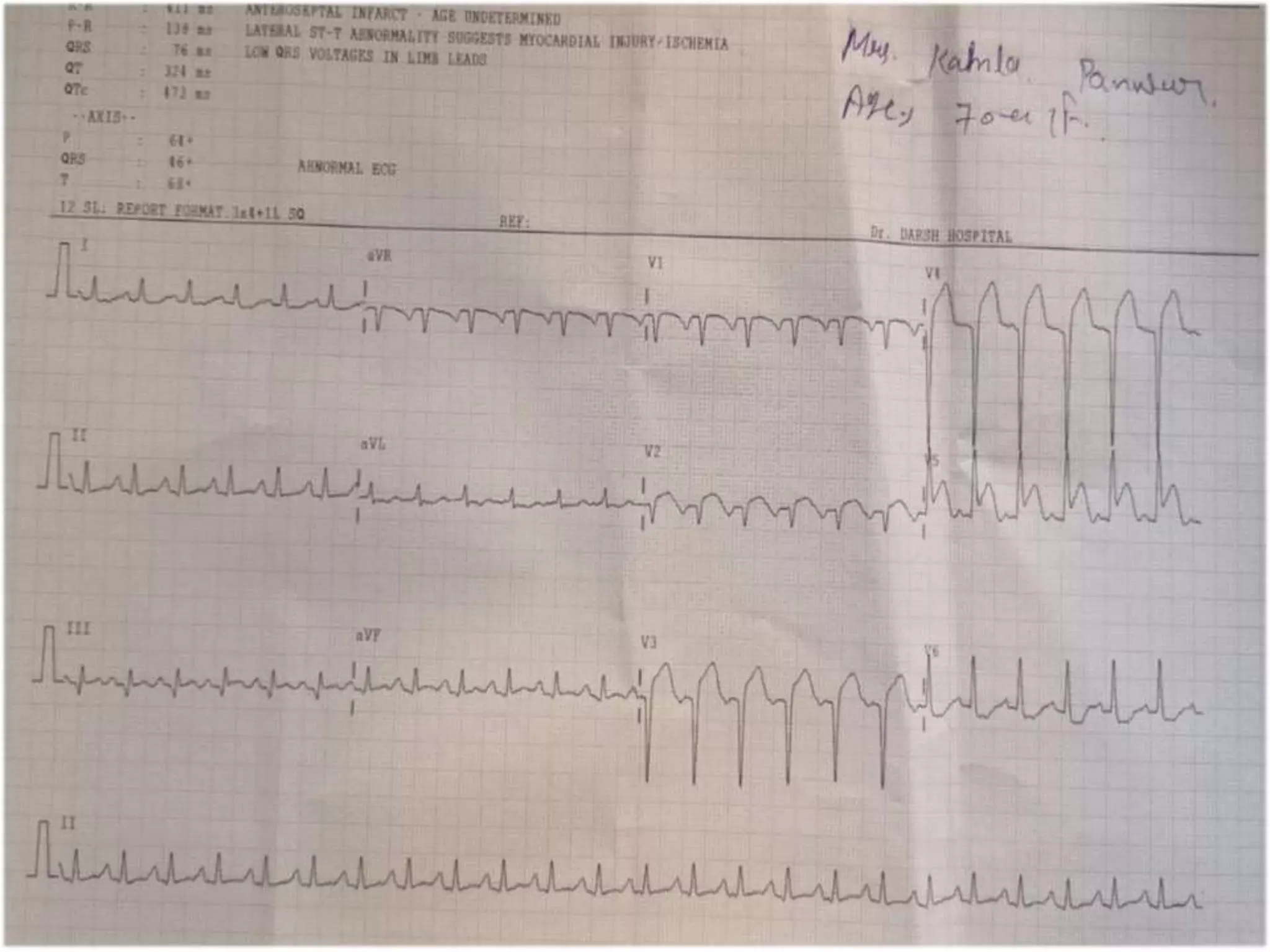 DIAGNOSIS AND MANAGEMENT OF ACS copy.pptx | Heart and Cardiovascular ...