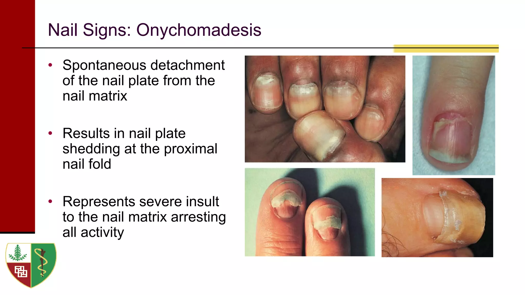 diagnosis_and_management_of_common_nail_disorders_-_yost.pdf