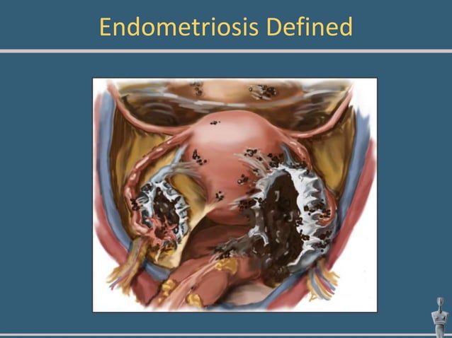 Diagnosis and management of endometriosis pathophysiology to practice | PPT Diagnosis and management of endometriosis pathophysiology to practice | PPT