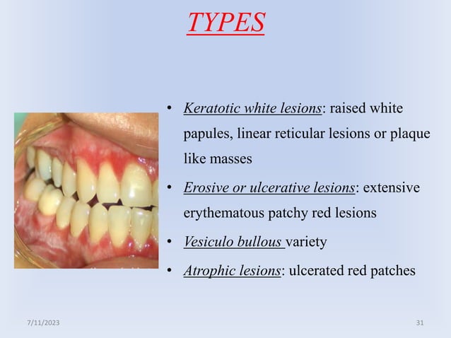 DIAGNOSIS AND MANAGEMENT OF GINGIVAL TUMORS final.ppt
