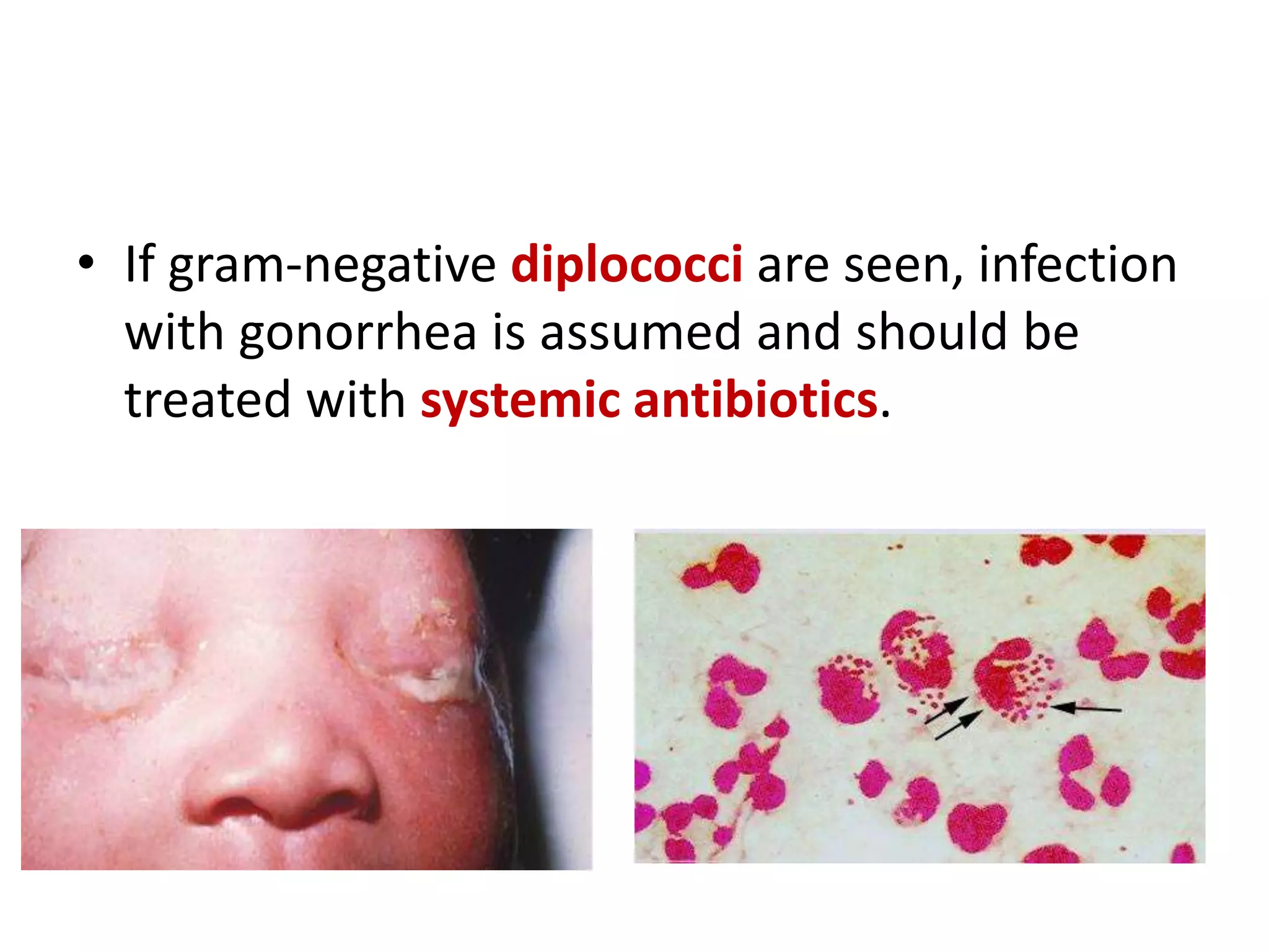 Diagnosis and management of pediatric conjunctivitis | PPTX