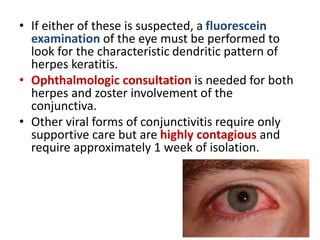 Diagnosis and management of pediatric conjunctivitis | PPTX
