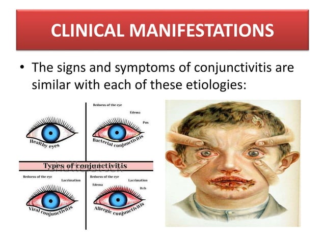 Diagnosis and management of pediatric conjunctivitis | PPTX | Ear, Nose ...