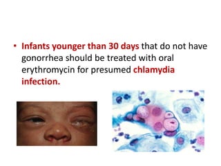 Diagnosis and management of pediatric conjunctivitis | PPTX