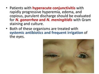 Diagnosis and management of pediatric conjunctivitis | PPTX