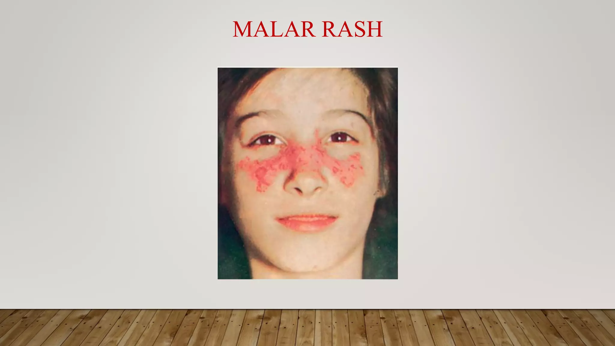 Diagnosis and management sle | PDF