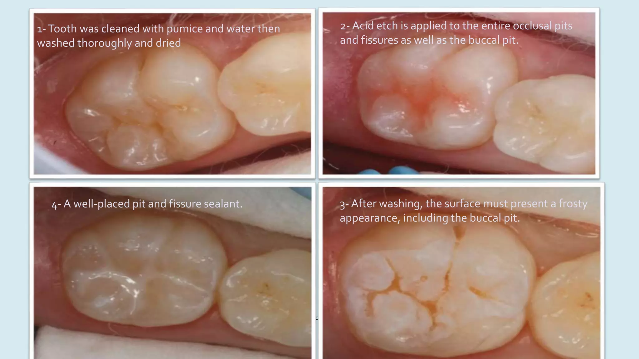 Diagnosis and prevention of dental caries | PPTX