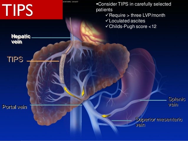 Diagnosis and Treatment of Ascites