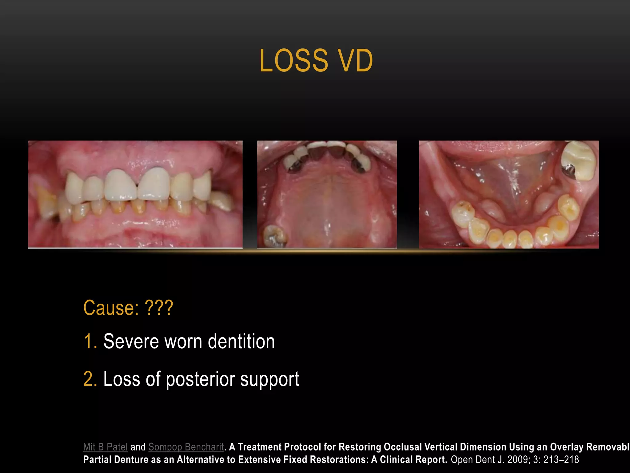 Diagnosis and treatment of choice in restoring vertical dimension | PPTX
