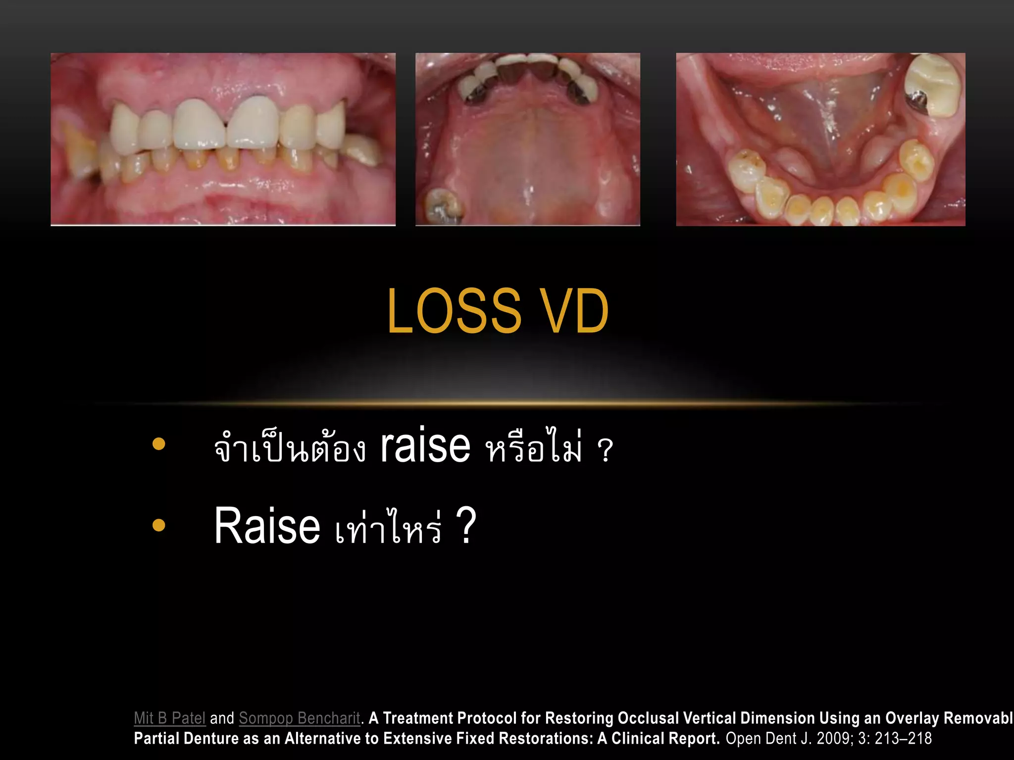 Diagnosis and treatment of choice in restoring vertical dimension | PPTX