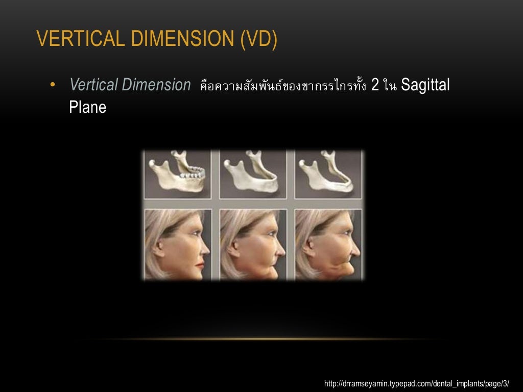 Diagnosis and treatment of choice in restoring vertical dimension