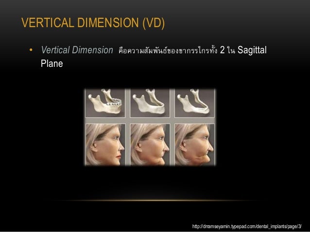 Diagnosis and treatment of choice in restoring vertical dimension