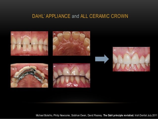 Diagnosis and treatment of choice in restoring vertical dimension