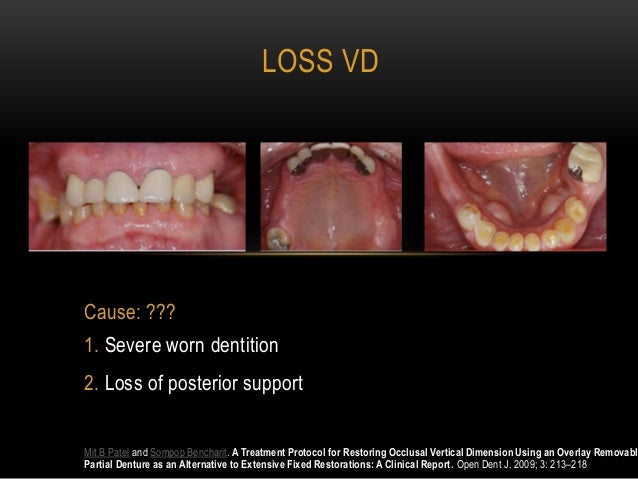Diagnosis and treatment of choice in restoring vertical dimension