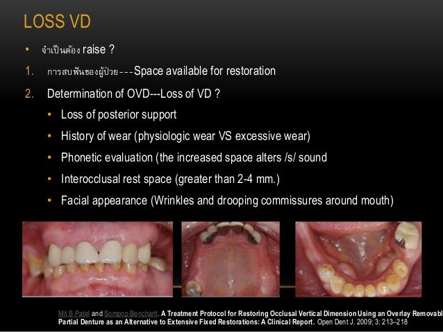 Diagnosis and treatment of choice in restoring vertical dimension