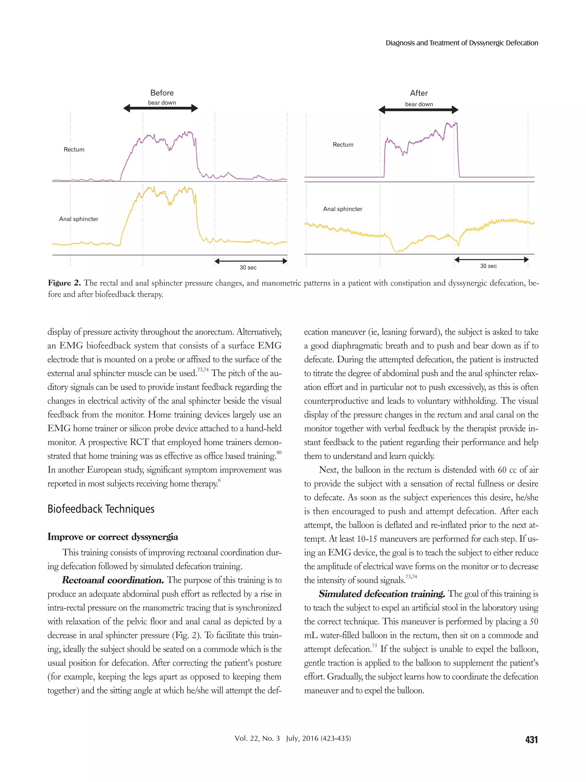 Diagnosis and treatment of Dyssynergic Defecation (Rao) | PDF