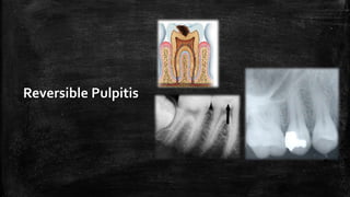 Diagnosis and Treatment of Endodontic Infection.pptx