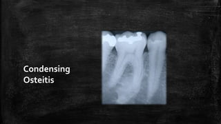Diagnosis and Treatment of Endodontic Infection.pptx