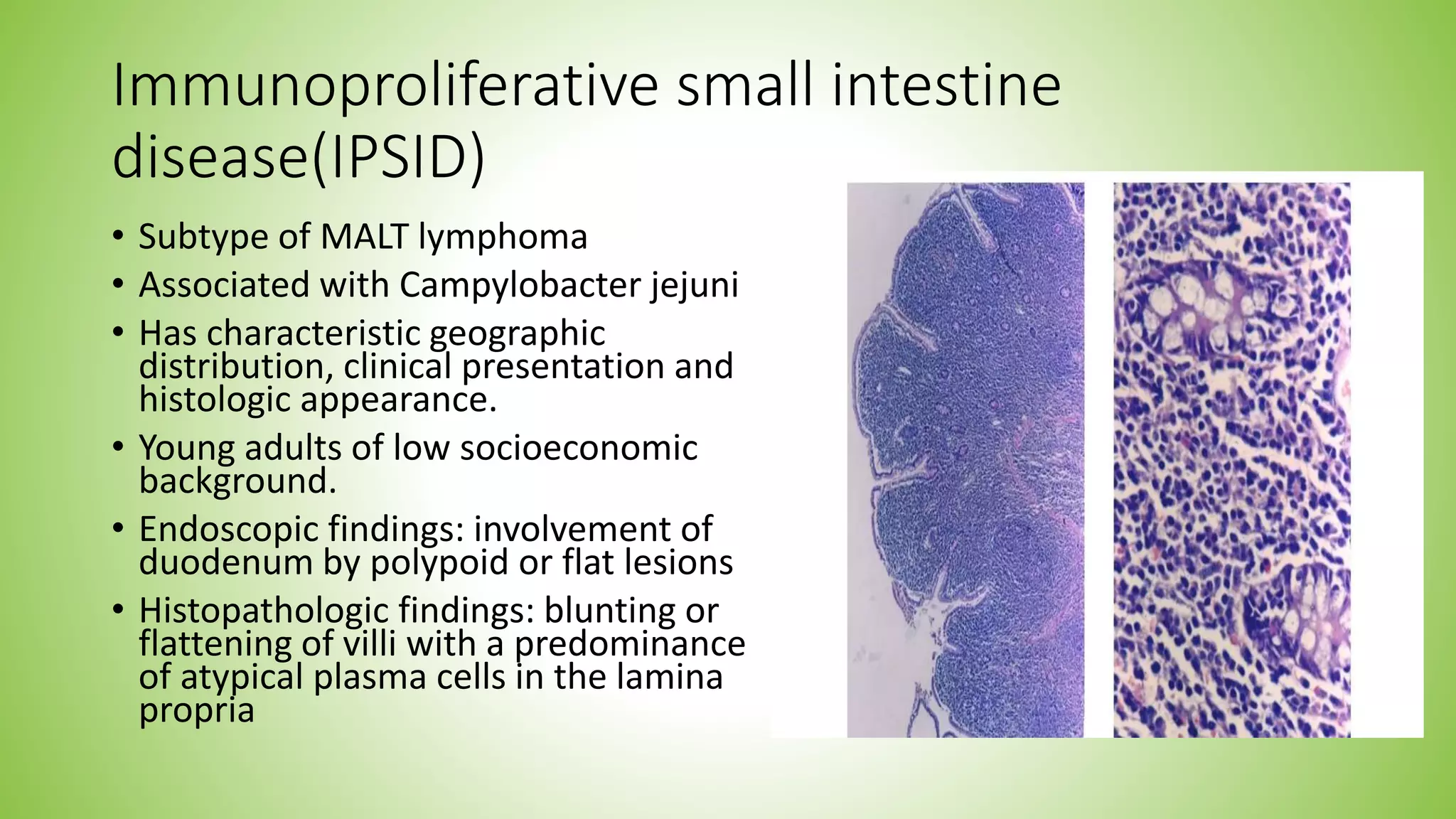 Diagnosis and treatment of gi malt lymphoma | PPTX