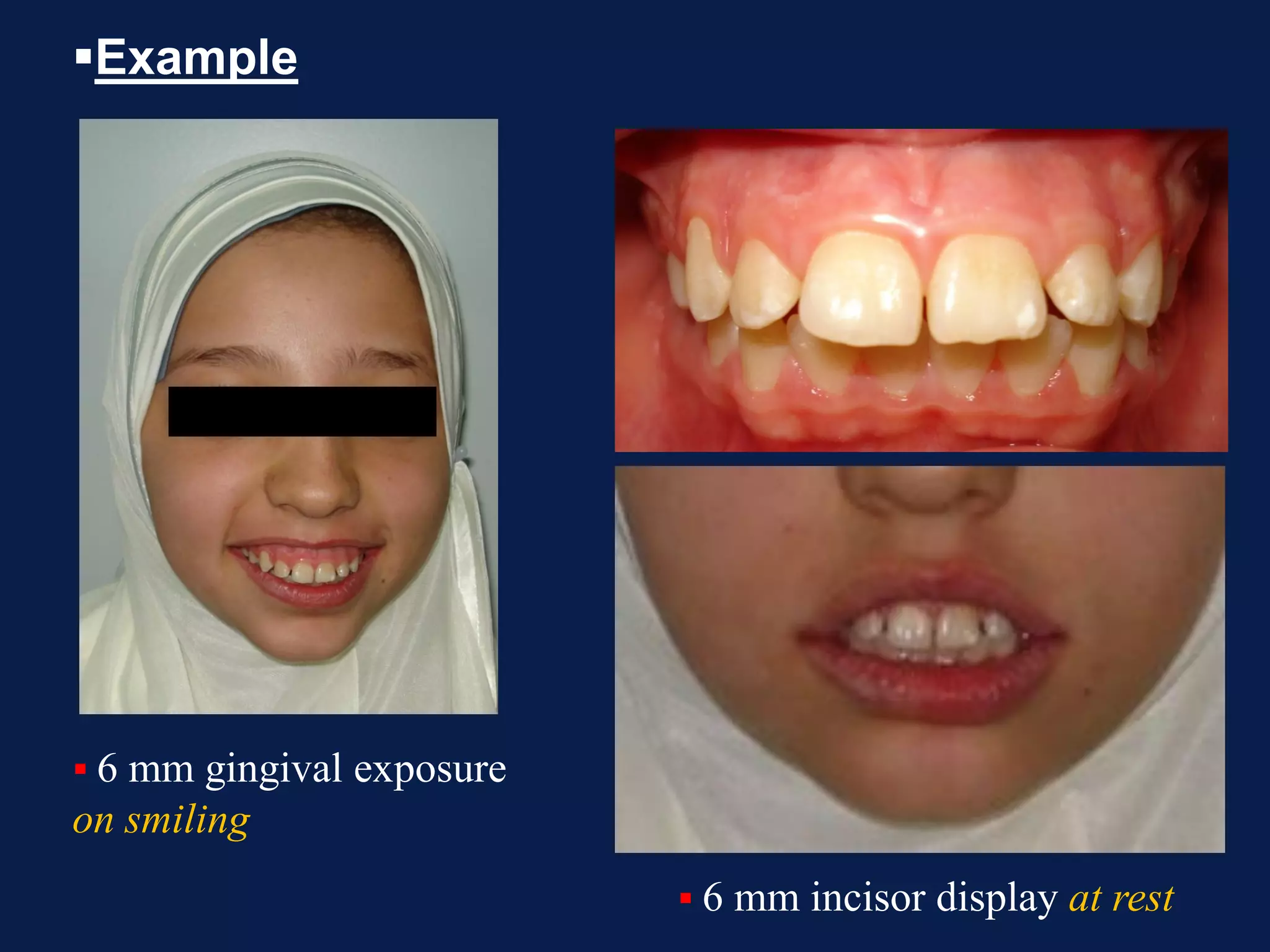 Diagnosis and treatment of gummy smile | PDF