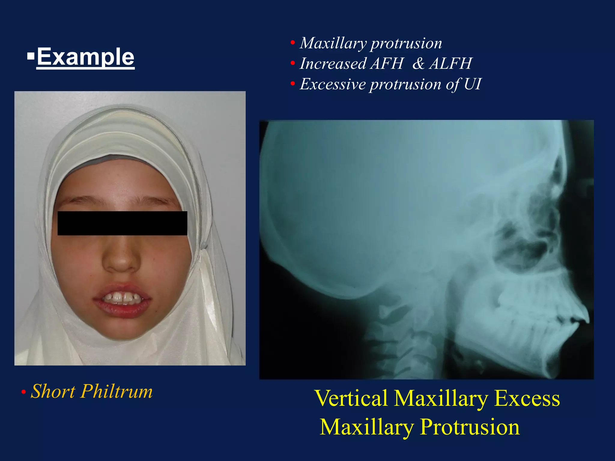 Diagnosis and treatment of gummy smile | PDF