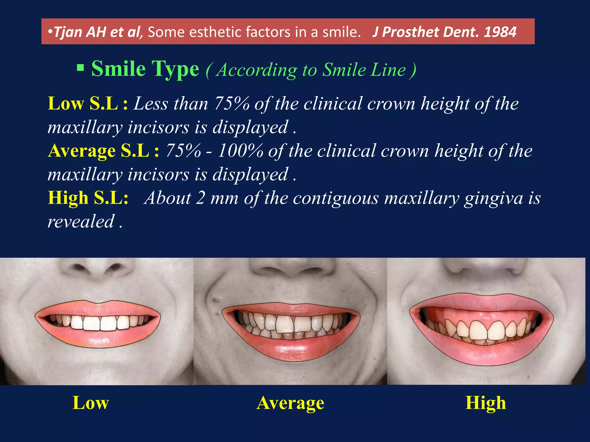 Diagnosis and treatment of gummy smile | PDF
