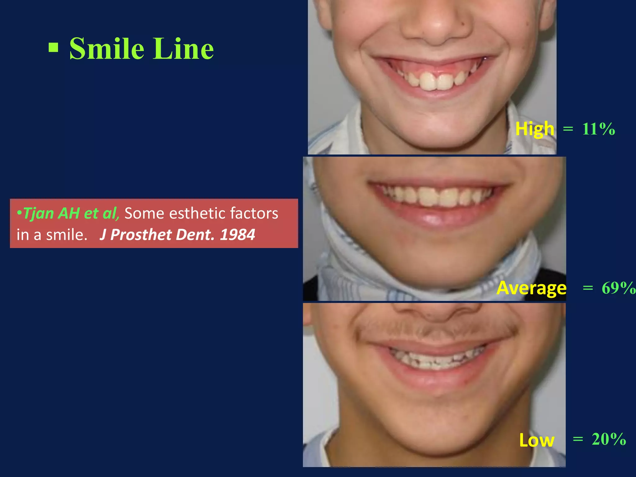 Diagnosis and treatment of gummy smile | PDF