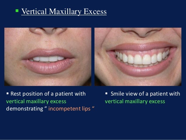 Diagnosis and treatment of gummy smile
