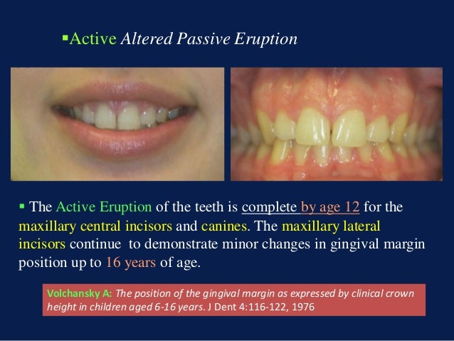 Diagnosis and treatment of gummy smile