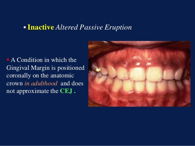 Diagnosis and treatment of gummy smile