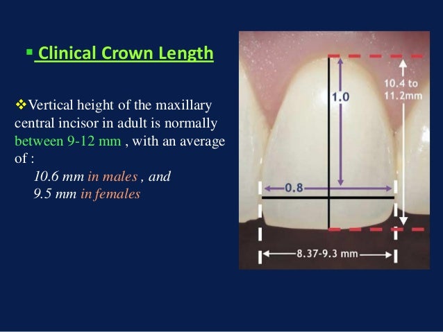 Diagnosis and treatment of gummy smile