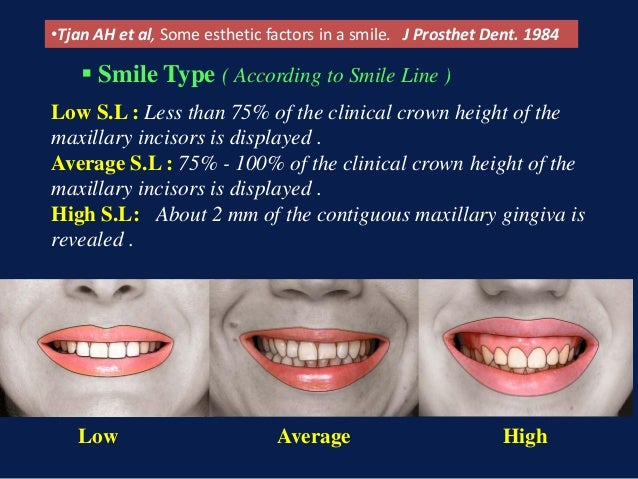 Diagnosis and treatment of gummy smile