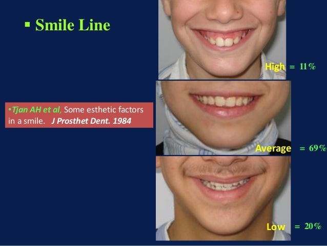 Diagnosis and treatment of gummy smile