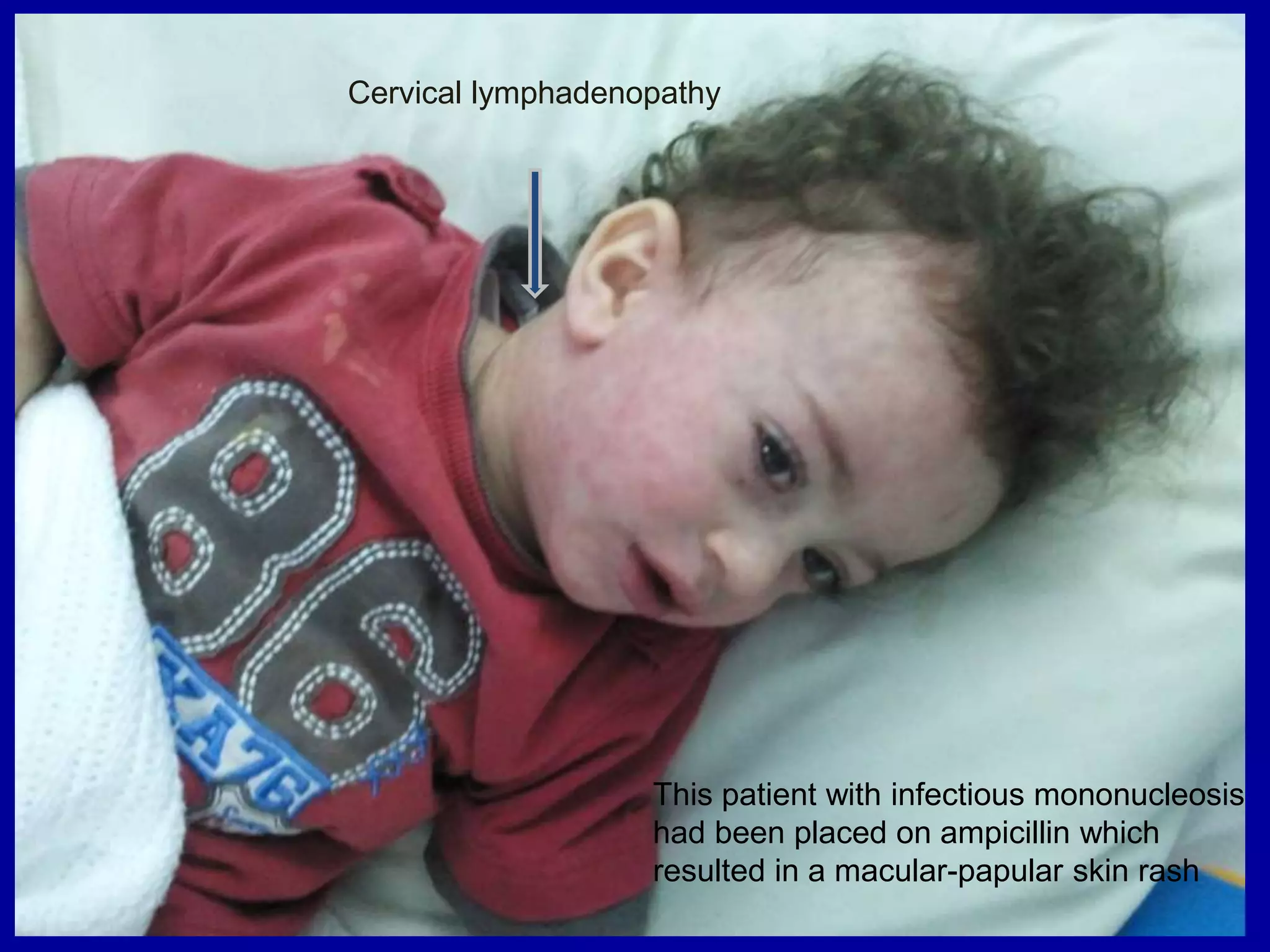 Diagnosis and treatment of URTI | PPTX