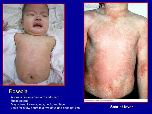 Diagnosis and treatment of URTI | PPTX