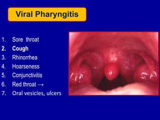 Diagnosis and treatment of URTI | PPT