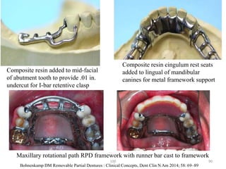 Diagnosis and treatment planning for removable partial dentures | PPTX