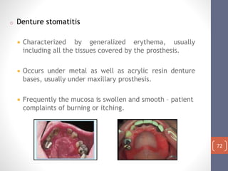 Diagnosis and treatment planning in rpd | PPTX