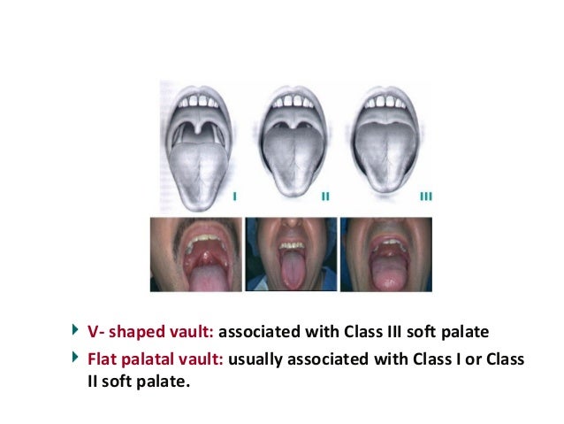 Hard Palate Abnormalities
