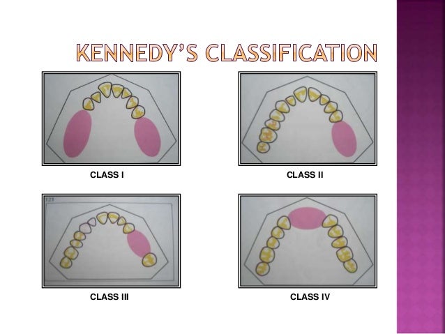 Diagnosis and treatment planning of Removable Partial Denture