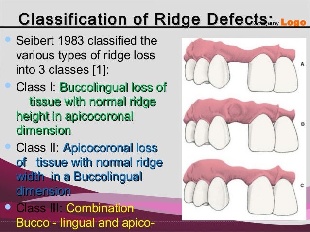 Classification of edentulous ridge - nelomuscle