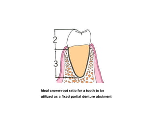 Diagnosis_and_tt_planning IN FIXED PARTIAL | PPT