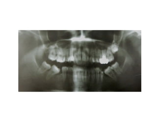 Diagnosis_and_tt_planning_in_FDP_II .ppt